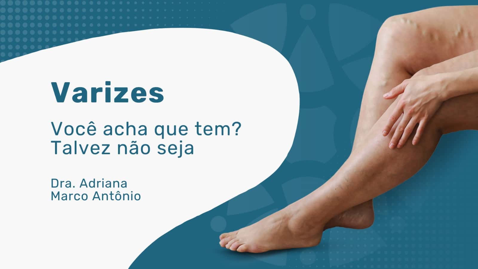 Varizes: o que é, como evitar e como tratar