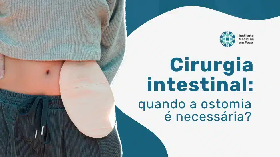 Cirurgia intestinal: quando a ostomia é necessária?